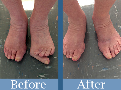 Overlapping and Underlapping Toes - Kevin J. Powers, DPMKevin J. Powers ...