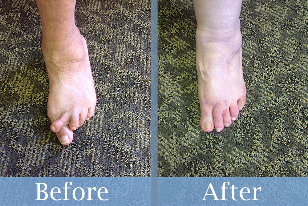 Rheumatoid Arthritis of the Foot and Ankle - Kevin J. Powers, DPMKevin ...